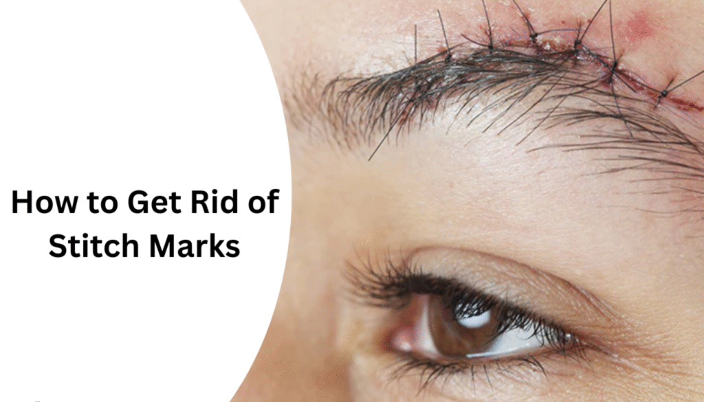 How to Get Rid of Stitch Marks in India